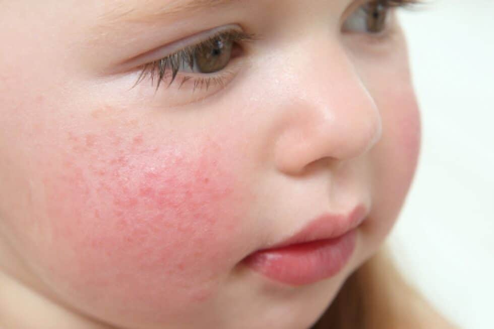 Dermatitis Atópica - Dermatólogo - Valencia | CLÍNICA DERMAR Dermatitis Atópica - Dermatólogo - Valencia | CLÍNICA DERMAR